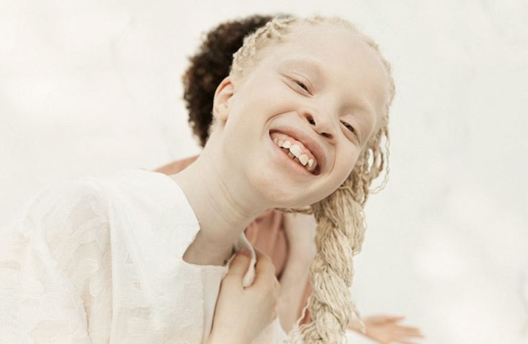 Charming Twins-Albinos Blow Up the Internet with their Unique Beauty.